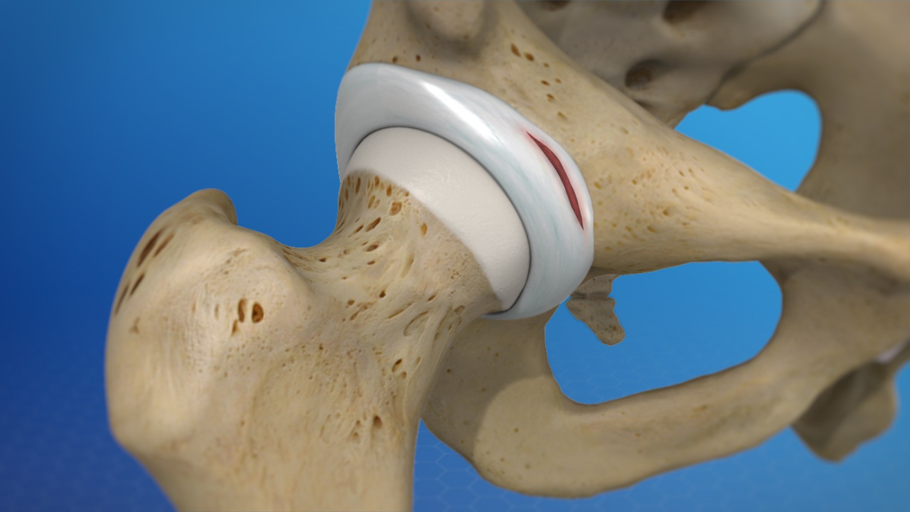 O QUE É O LABRUM ACETABULAR E QUAL A SUA FUNÇÃO? – Dr Rafael Tavares